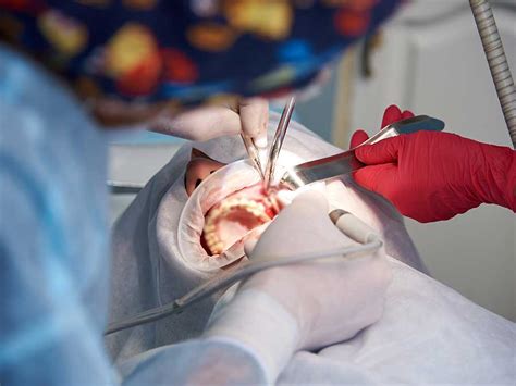 Sinus Lift Surgery Elevating Your Dental Implant Success Mcnally