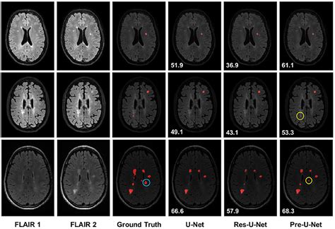 Frontiers New Multiple Sclerosis Lesion Segmentation And Detection