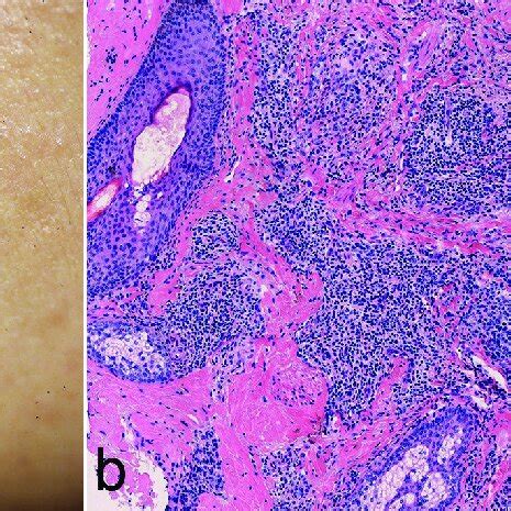 Clinical And Histological Features A Multiple Small Sized Papules