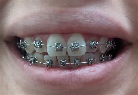 Day One Of Braces My Teeth Are So Sore 🫤 Rbraces
