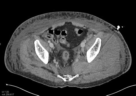 Cellulitis And Myositis Left Thigh And Buttocks Musculoskeletal