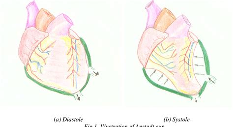 Figure 1 From Design And Construction Of A Left Ventricular