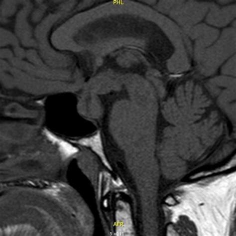 Granulomatous Hypophysitis Eurorad