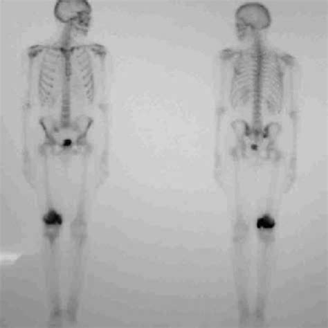 Pdf Myositis Ossificans Mimicking Parosteal Osteosarcoma A Case