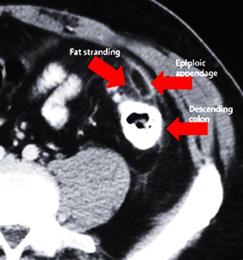 Epiploic Appendagitis