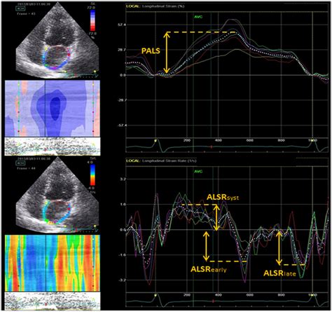 Measurement Of Left Atrial Strain Top And Strain Rate Download Scientific Diagram