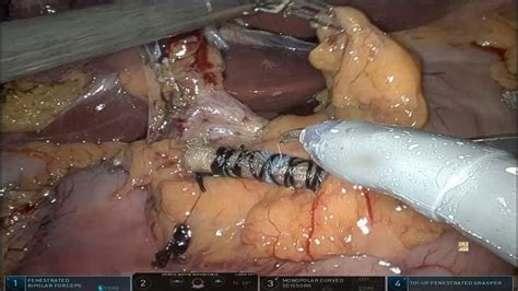 Robotic D2 Gastrectomy Part 2 Of 4 Youtube