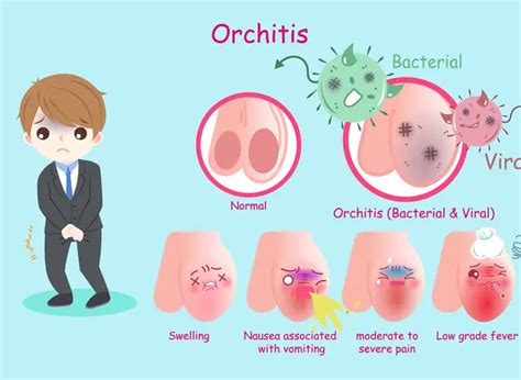 Orquitis Causas Síntomas Y Tratamiento Doctor Online