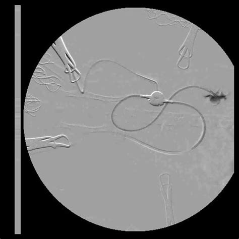 Subcutaneous Ureteral Bypass Galvao Otoni Internalmedicine Vca Arboretum View Subcutaneous Ureteral Bypass Galvao Otoni Internalmedicine Vca Arboretum View