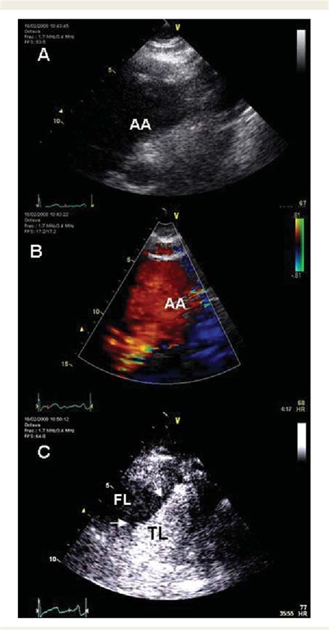 Table 1 From Impact Of Contrast Enhanced Echocardiography On The
