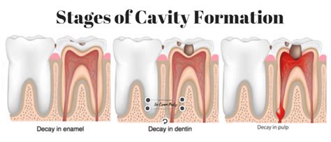 Dental Cavities Oceansight Dental And Implants