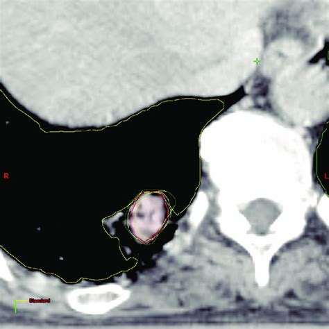 Gross Tumor Volumes Gtvs For 10 Phases Were Delineated The Figure