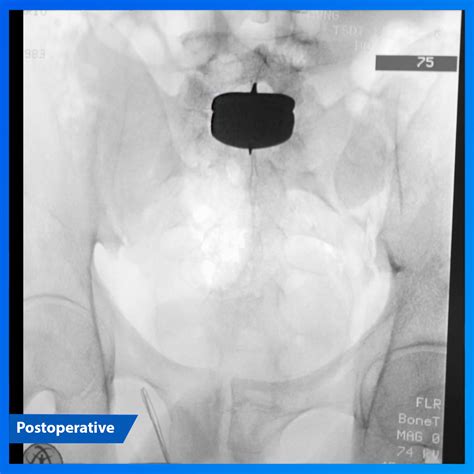 Artroplastia L5 S1 Con Prótesis Prodisc® L Medcomtech
