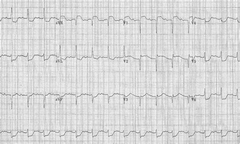 ECG Case 186 Widespread Subendocardial Ischaemia Manual Of Medicine