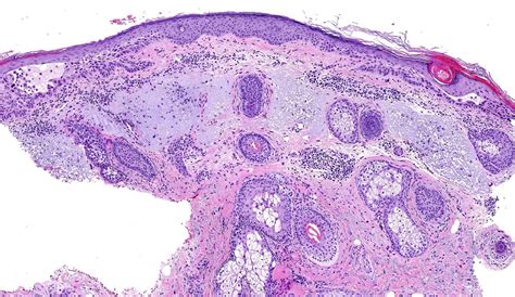 Bowens Disease Pathology Outlines