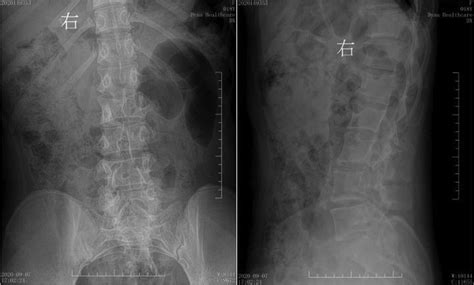 Preoperative Digital Radiography Spina Bifida Is Shown In The Lumbar