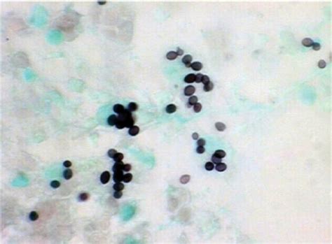 Cytology Of Lymph Node Aspirate Many Yeast Like Fungal Forms Of Round Download Scientific
