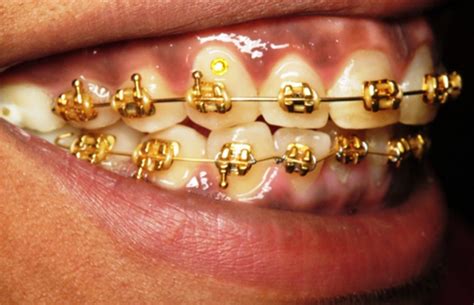 Only In Hollywood Diamond Braces For 25000 Teeth Braces Gold