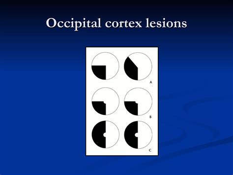 Anatomy And Lesions Of Visual Pathways Ppt