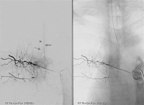 Spinal Artery Test Occlusion And Sacrifice For Tumor Embolization