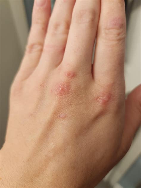 Got Shingles At 43 On Torso Rshingles