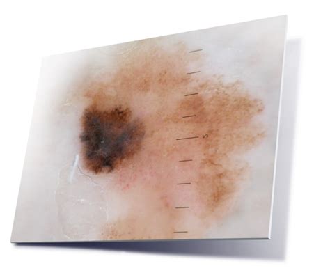 Dermtest Get Suspicious Moles Checked