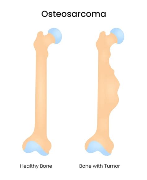Premium Vector Osteosarcoma Of Healty Bones And Bones With Tumors
