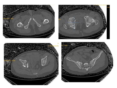 Imaging And Classification Of Acetabular Fractures Pptx
