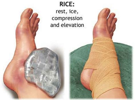Worldofvolley Rice Rest Ice Compression And Elevation
