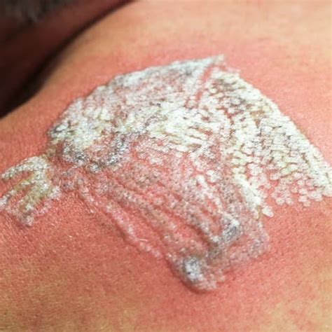 Tattoo Removal Healing Process Well Medical Arts West Seattles