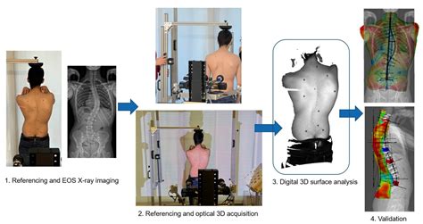 3d Scanning For Scoliosis Diagnostics Photoneo Focused On 3d