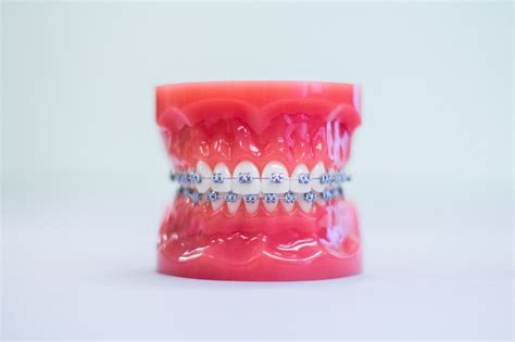 Metal Braces Orthodontic Associates