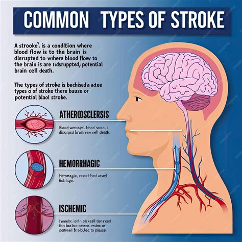 Informative Poster On Common Types Of Stroke Premium Ai Generated Image