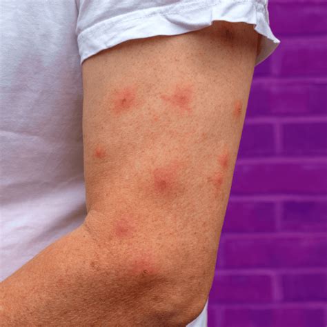 Bed Bug Bites Symptoms Time