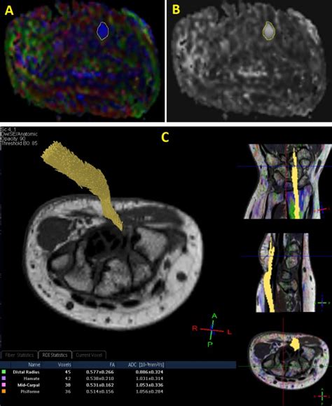 Color Coded Fa Map Image A Fa Map Image B Tractography Of The