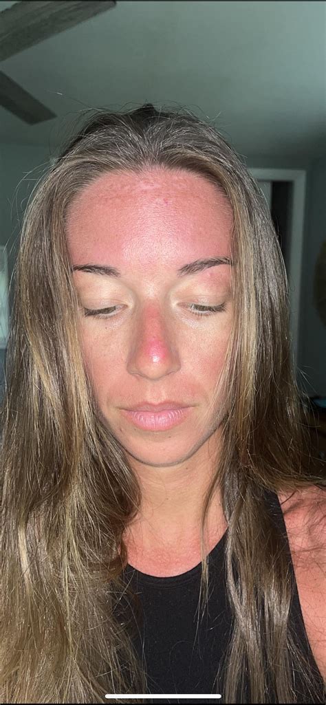 Bright Pink Red Patch On Nose R Dermatologyquestions