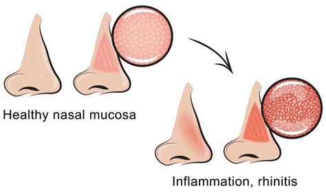 All About Allergic Rhinitis