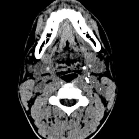 Ct Scan With 3d Volume Rendering Reconstruction Shows Elongated Styloid