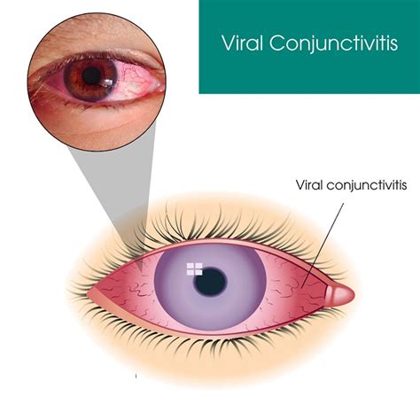 Seasonal Allergic Conjunctivitis