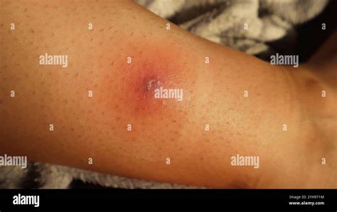 An Inflamed Swollen Area On The Skin Indicating An Infection Or