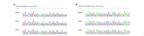 Sanger Sequences Demonstrated Compound Heterozygous Mutations Of The