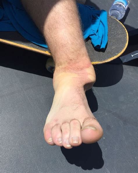 Minor Dislocated Ankle