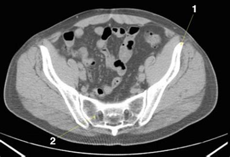 Imagenoncontrast Ct Scan Of The Abdomen And Pelvis Showing Normal
