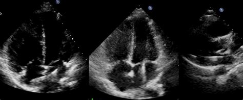 Malposition Of The Pacemaker Lead In The Left Ventricle Revista