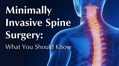Minimally Invasive Spine Surgery What You Should Know