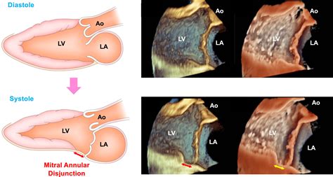 Mitral Annular Disjunction—a New Disease Spectrum Cardiology Clinics