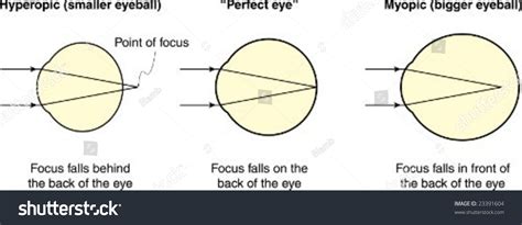 Hyperopic Myopic Eyes Stock Vector Royalty Free 23391604 Shutterstock