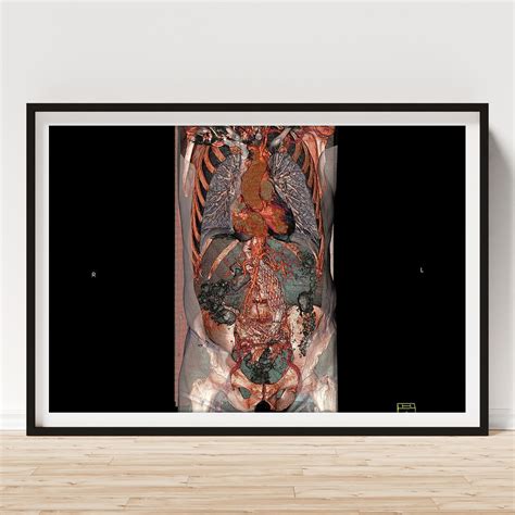 Aortic Aneurysm Stent Poster By Science Photo Library Science Photo