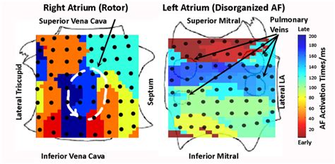 Mapping Localized Sources In A 66 Year Old Gentleman With Persistent