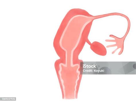 Congenital Anomalies Of The Uterus Class U4 Unicornuate Uterus Stock